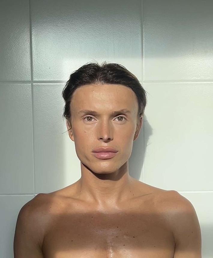 Kivuliaissa kauneusoperaatioissa käynyt Sergey Hilman: ennen ja jälkeen -kuvat! | Seiska